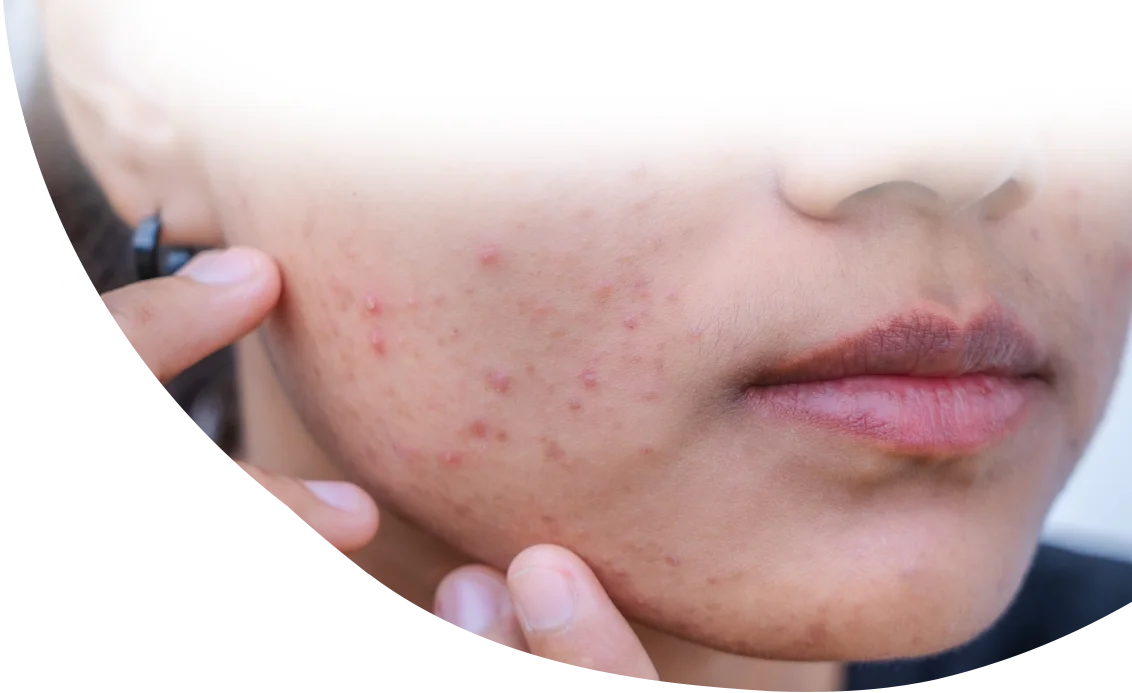 Acne | Derma Birmingham